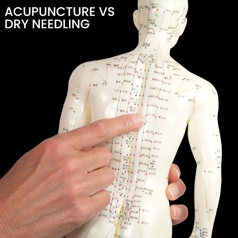 Dry Needling vs Acupuncture vs Acupressure for Pain Relief - Coach Sofia Fitness