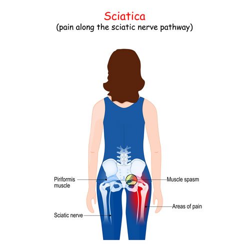 5 Easy Ways to Relieve Sciatica Fast! - Coach Sofia Fitness