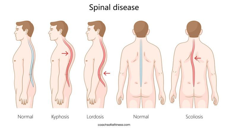 Is Your Spine Out of Alignment? How to Tell if You Have Kyphosis, Lordosis, or Scoliosis - Coach ...